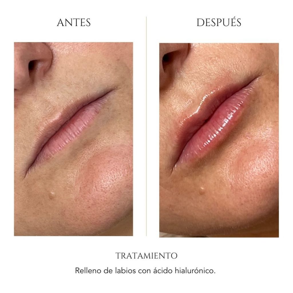 Transforma tu sonrisa con el relleno de labios con ácido hialurónico